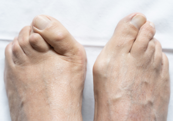 Mallet Toe - The Foot Doctor